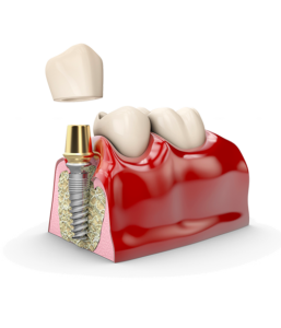 Inlay core - Clinique dentaire Elysées Ponthieu - Dentiste Paris 8