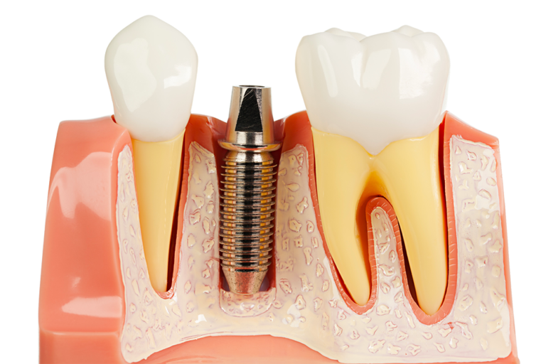 Inlay core - Clinique dentaire Elysées Ponthieu - Dentiste Paris 8