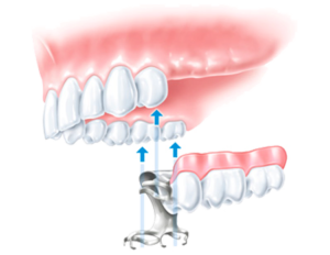 Prothèse adjointe - Clinique dentaire Elysées Ponthieu - Dentiste Paris 8